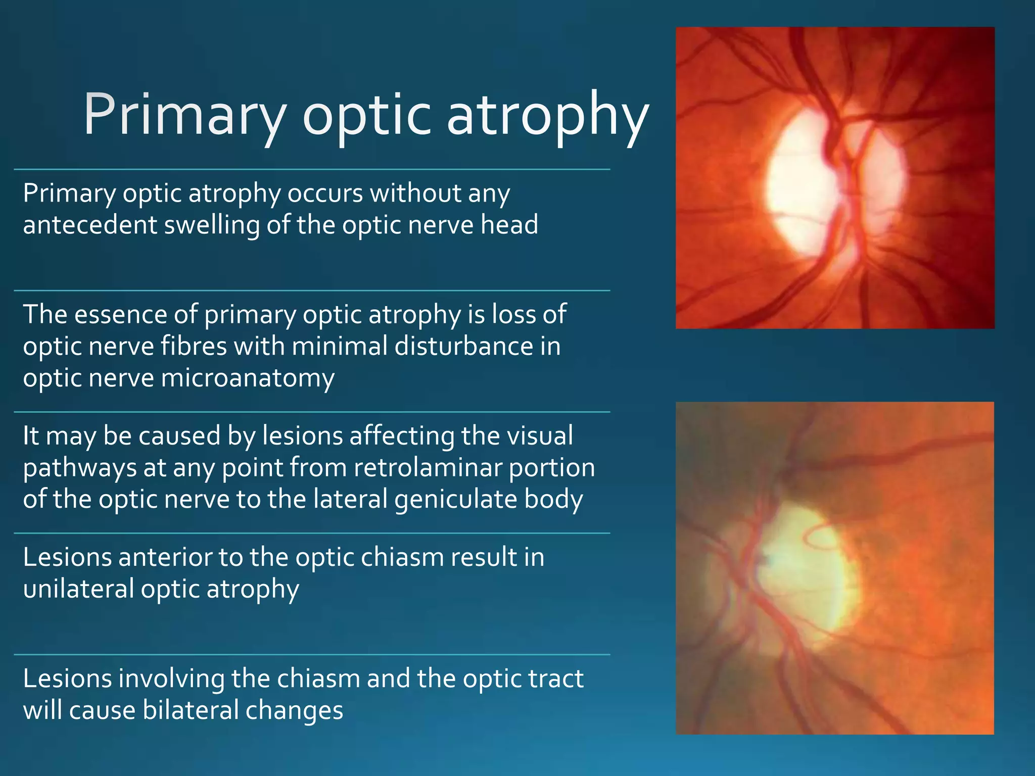 Optic atrophy | PPTX