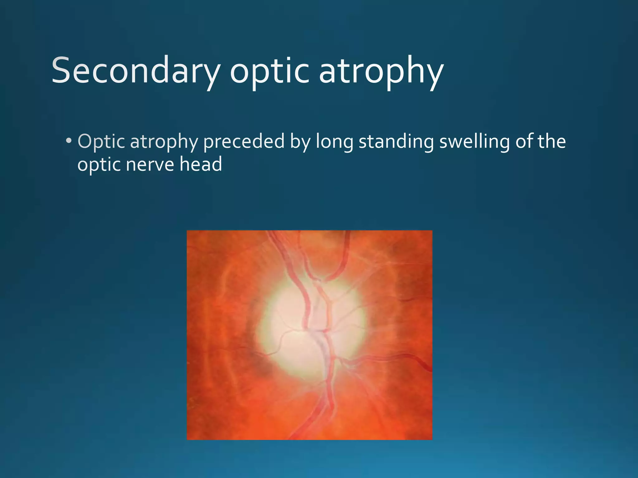 Optic atrophy | PPTX