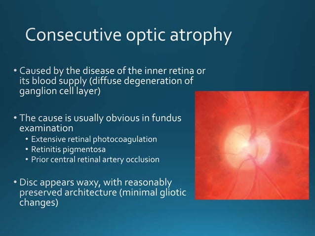 Optic atrophy | PPTX