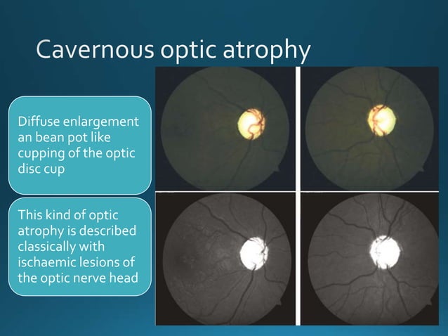 Optic atrophy | PPTX