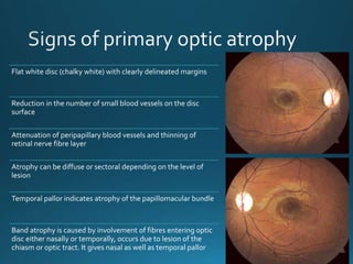 Optic atrophy | PPTX