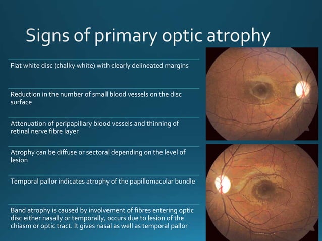 Optic atrophy | PPTX