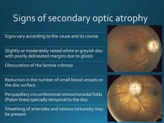 Optic atrophy | PPTX