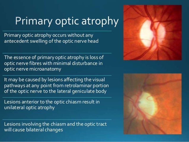 Optic atrophy