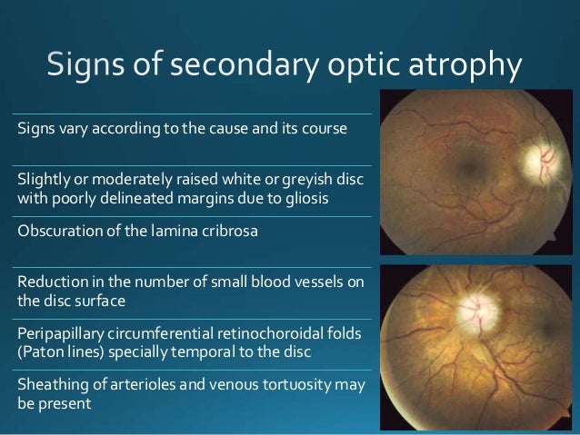 Optic atrophy