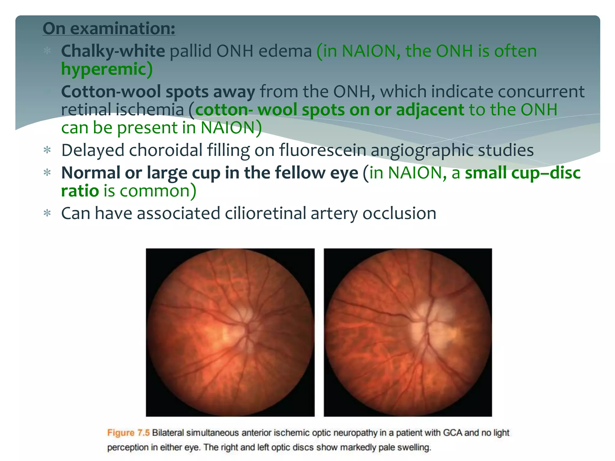 Optic atrophy | PPTX