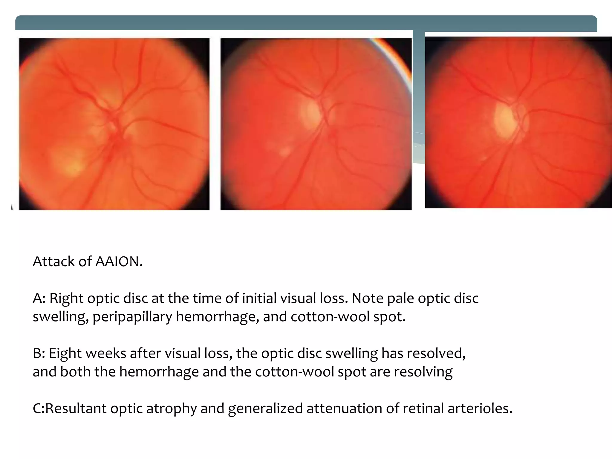 Optic atrophy | PPTX