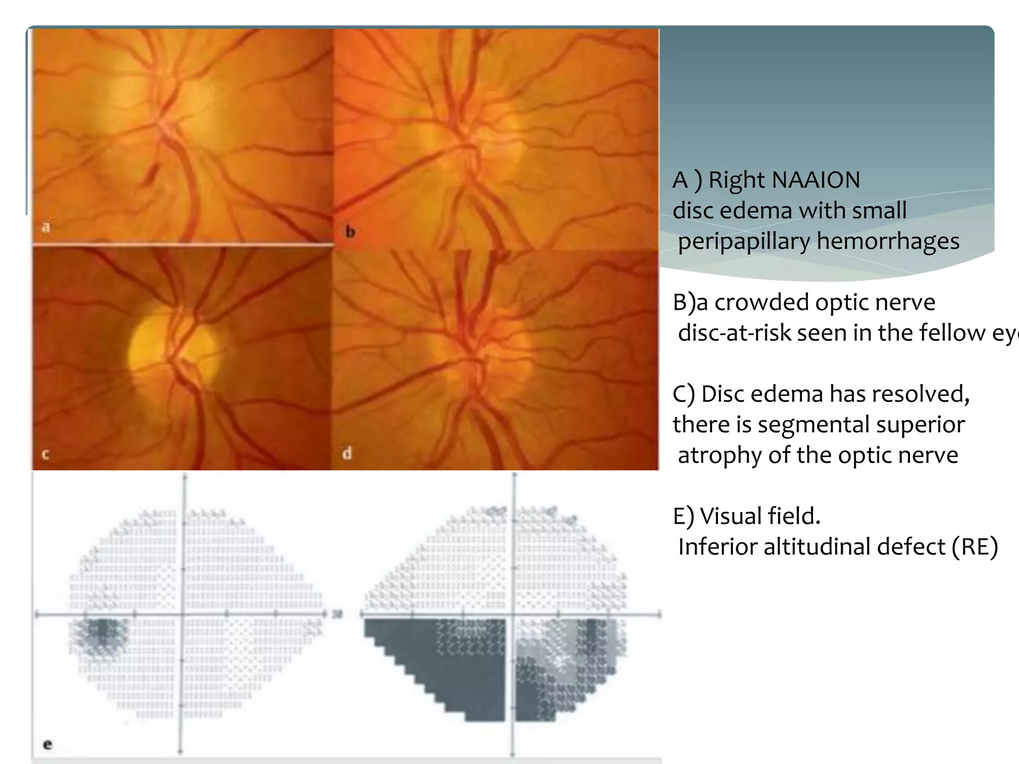 Optic atrophy | PPTX