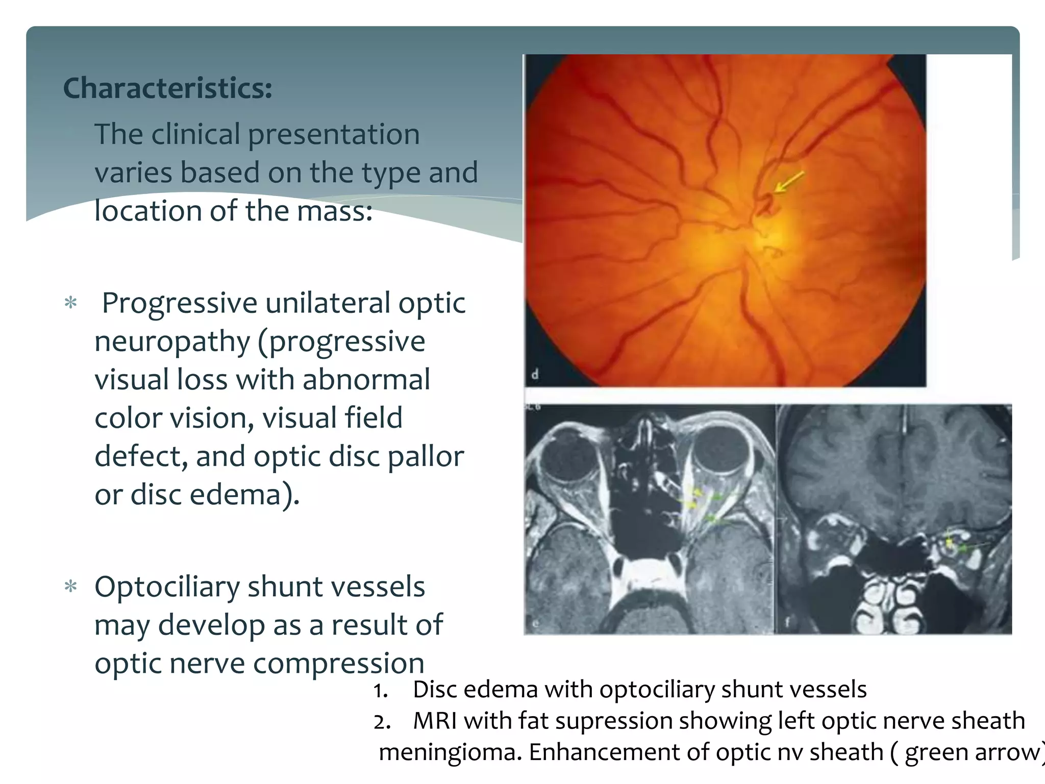 Optic atrophy | PPTX