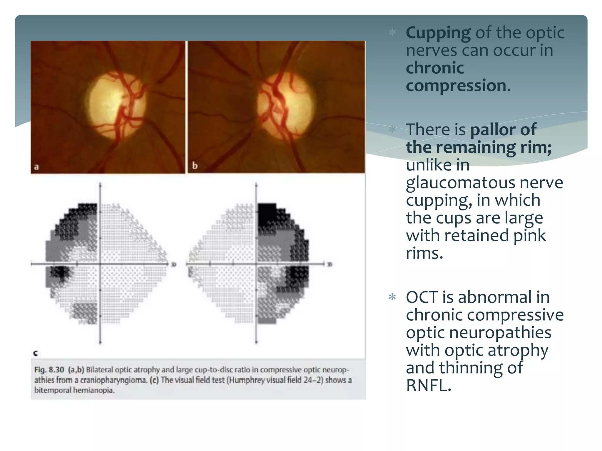 Optic atrophy | PPTX