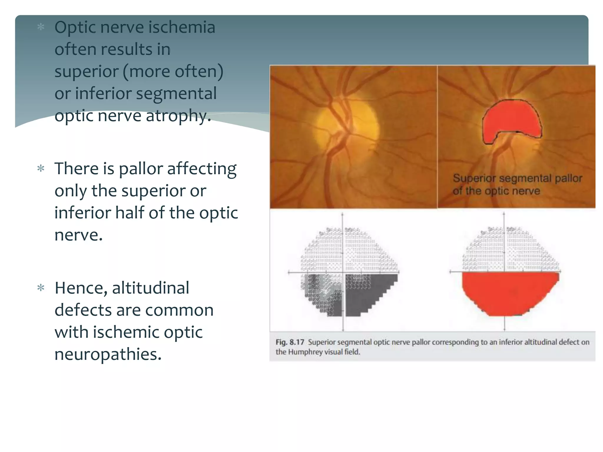 Optic atrophy | PPTX