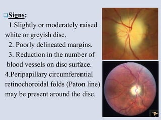 Optic Atrophy | PPTX