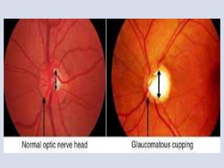 Optic Atrophy | PPTX