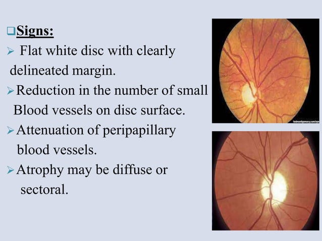Optic Atrophy | PPTX | Eye and Vision Conditions | Diseases and Conditions