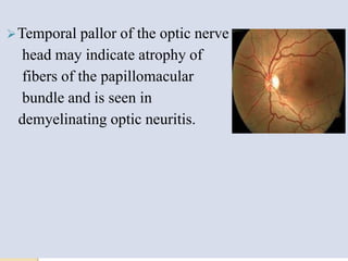 Optic Atrophy | PPTX