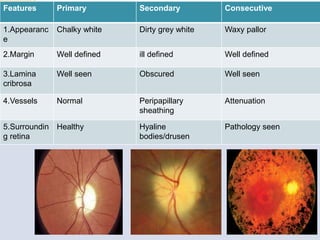 Optic Atrophy | PPT