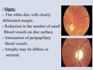 Optic Atrophy | PPT
