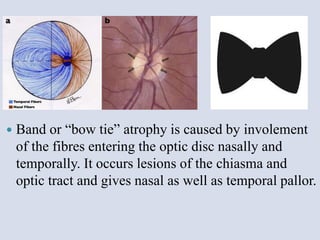 Optic Atrophy | PPT