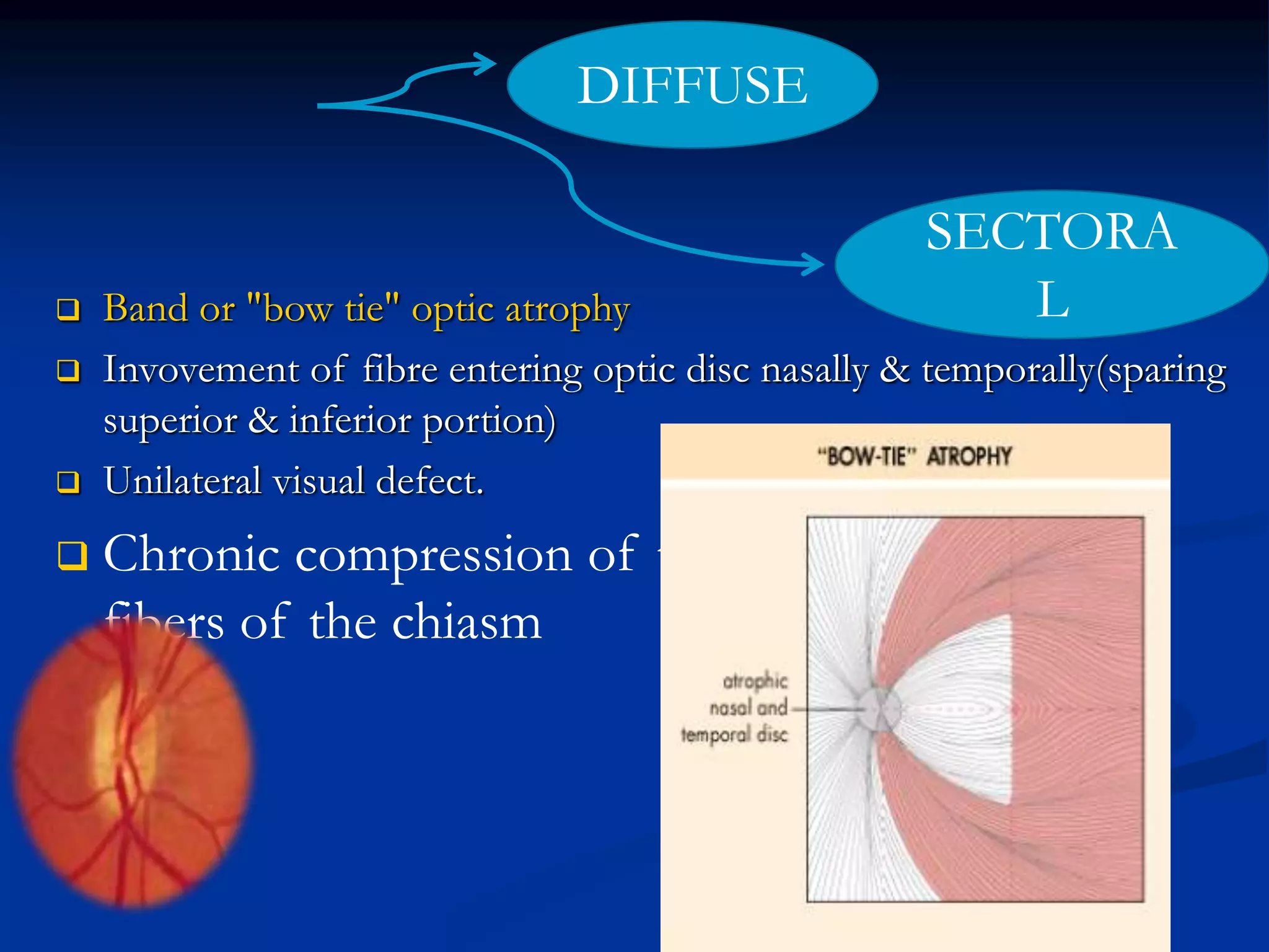 optic atrophy.ppt