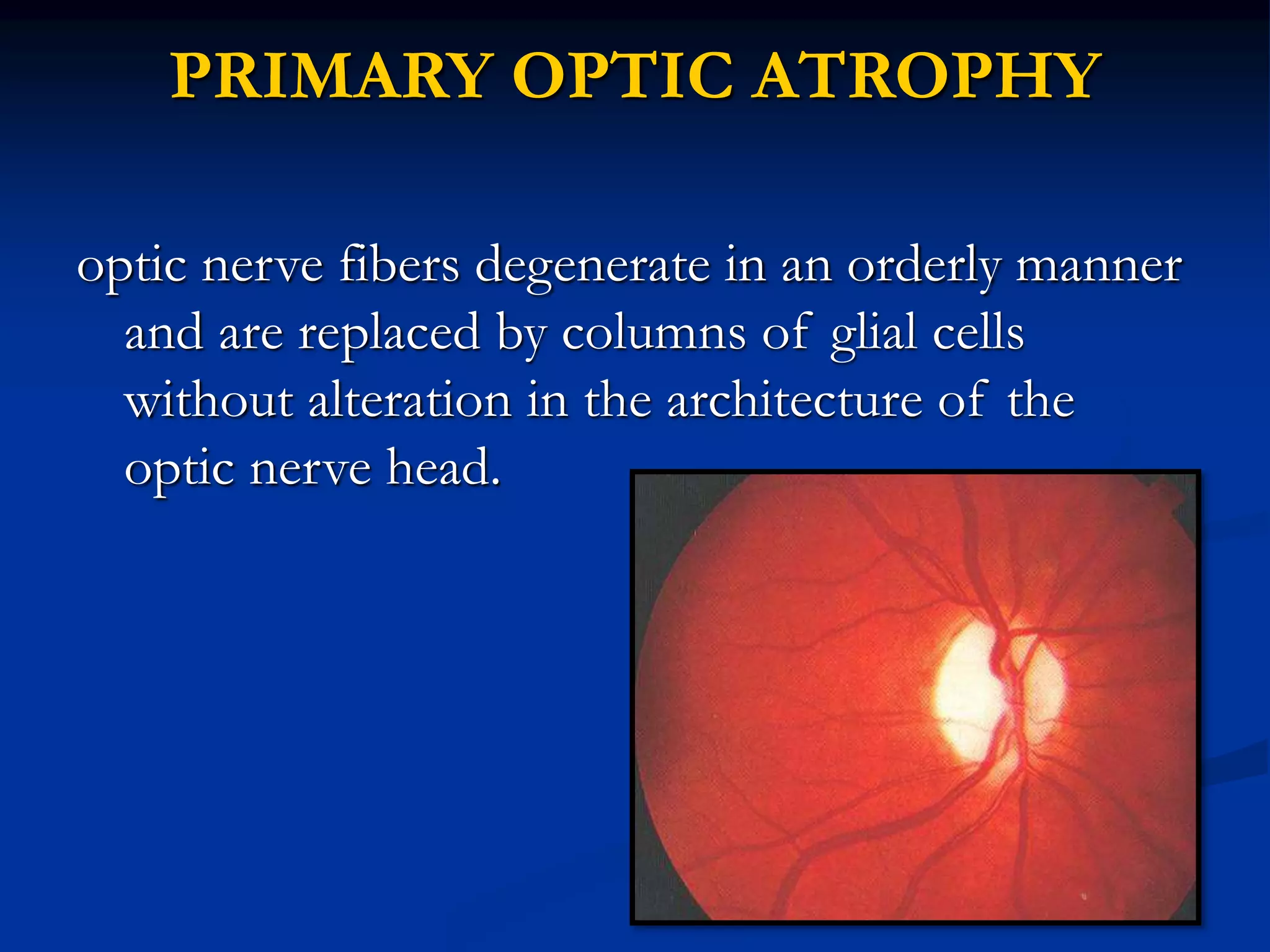 optic atrophy.ppt