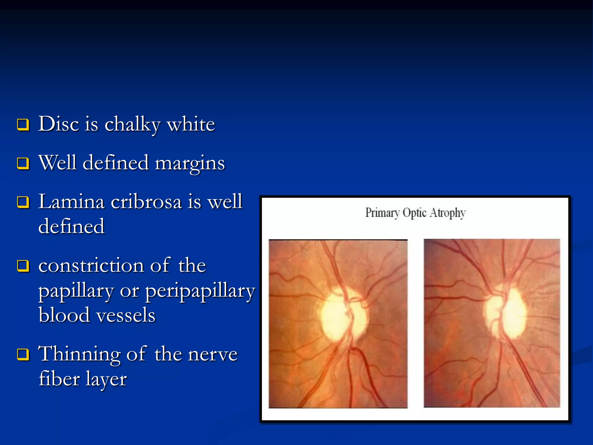 optic atrophy.ppt