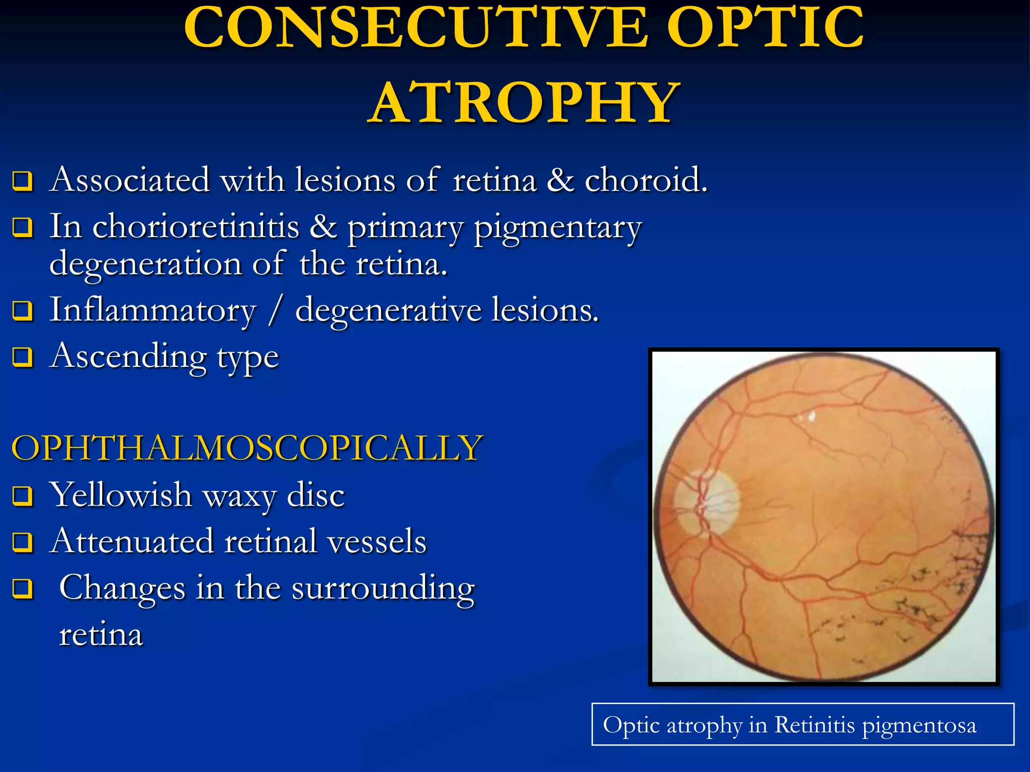 optic atrophy.ppt