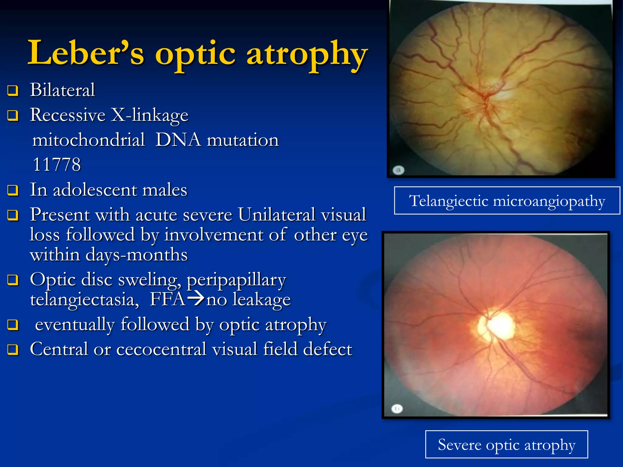 optic atrophy.ppt