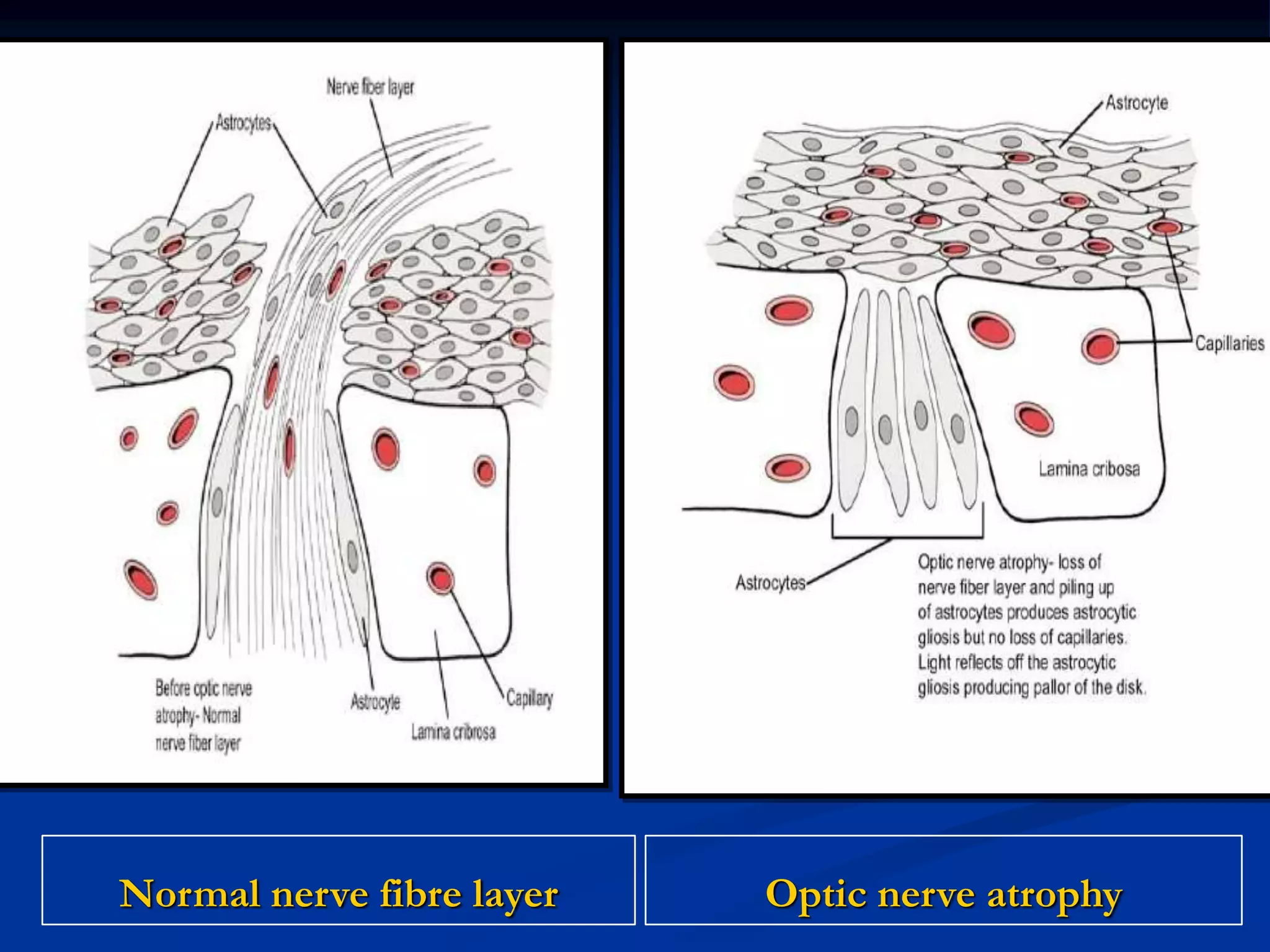 optic atrophy.ppt