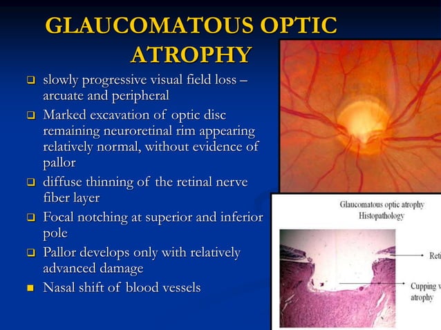 optic atrophy.ppt | Eye and Vision Conditions | Diseases and Conditions