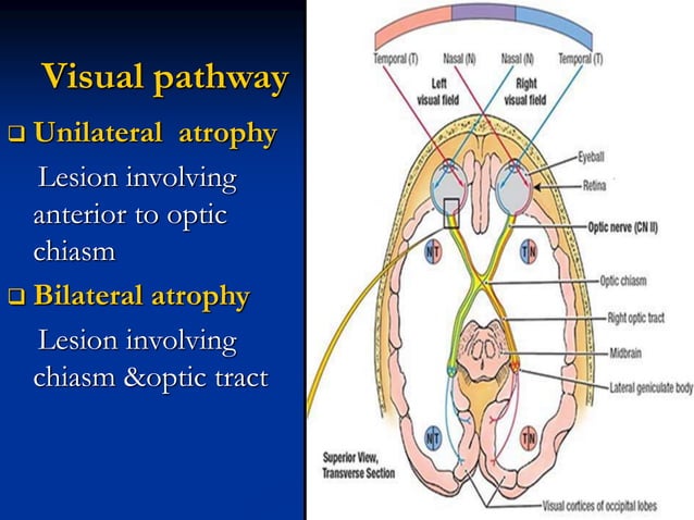 optic atrophy.ppt | Eye and Vision Conditions | Diseases and Conditions
