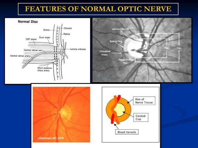 optic atrophy.ppt | Eye and Vision Conditions | Diseases and Conditions
