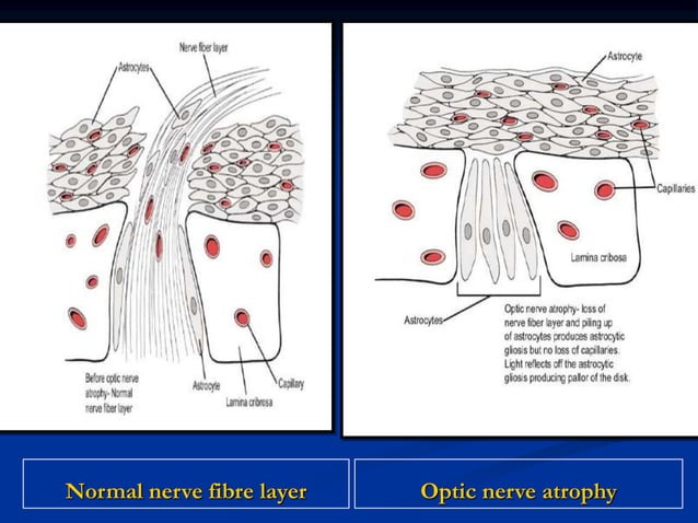 optic atrophy.ppt | Eye and Vision Conditions | Diseases and Conditions