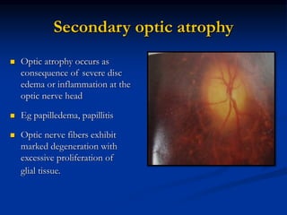optic atrophy.ppt