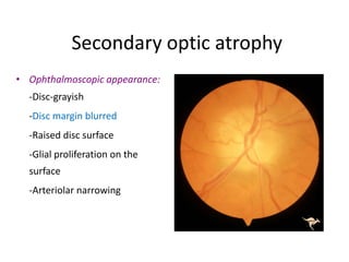 optic atrophy.pptx