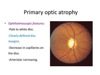 optic atrophy.pptx