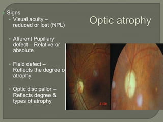 OPTIC ATROPHY.pptx