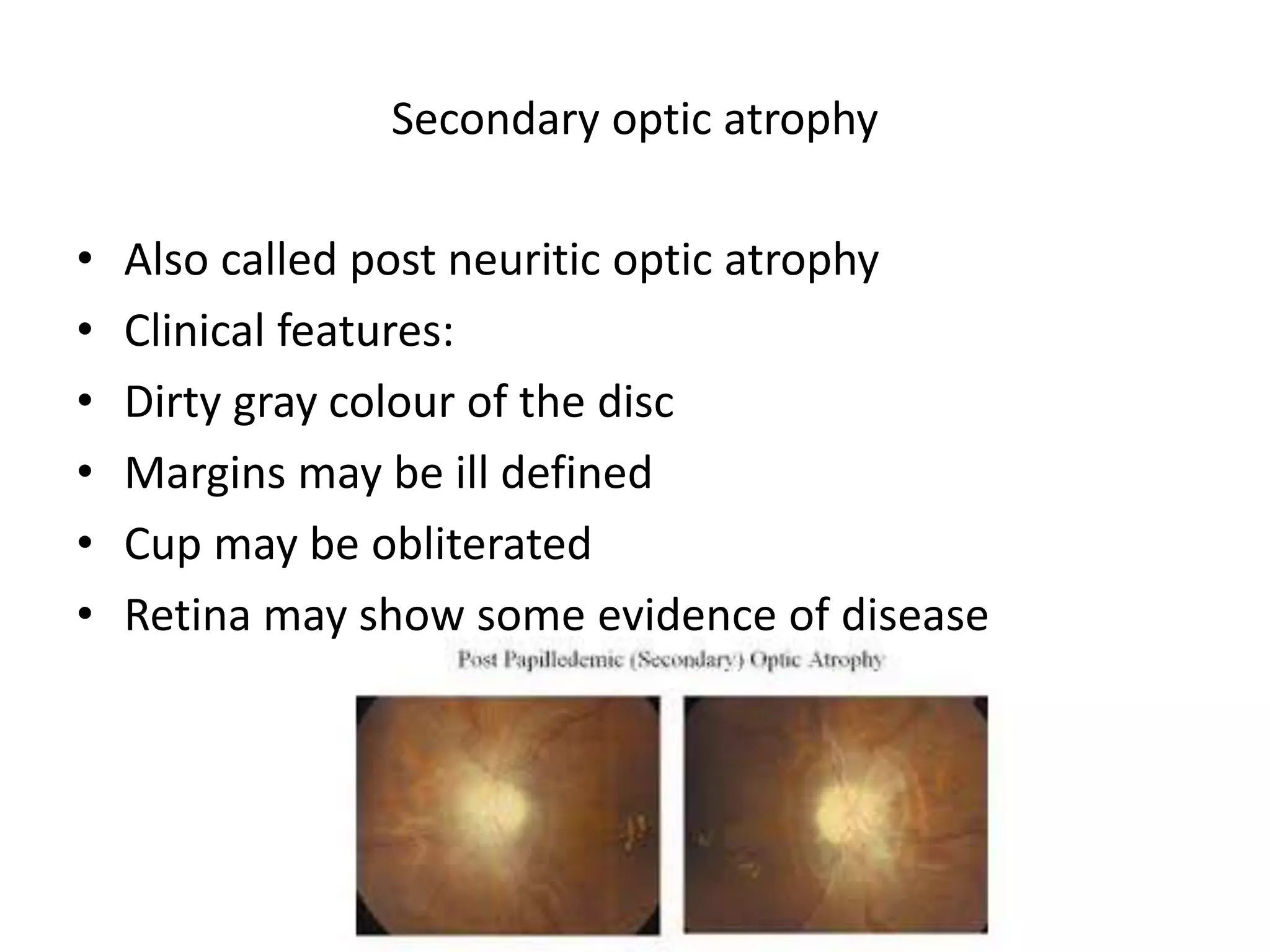 Optic atrophy dr.k.srikanth ,19.05.16