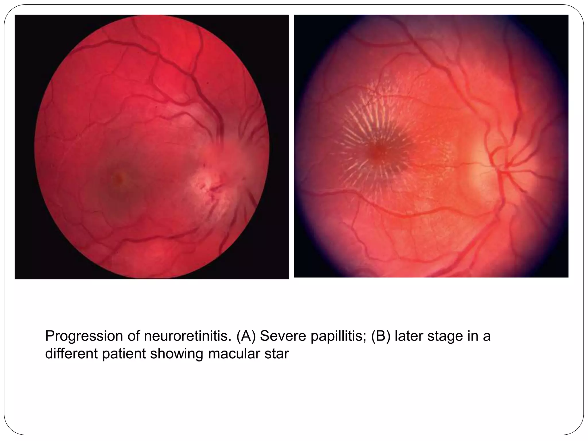 Optic atrophy and neuroretinitis | PPTX
