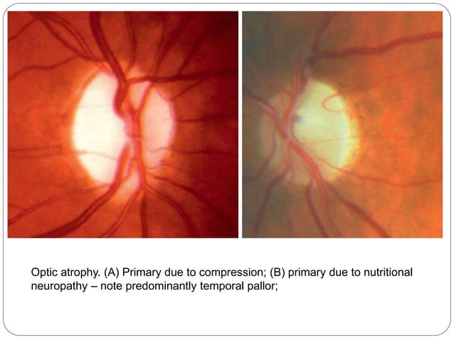 Optic atrophy and neuroretinitis | PPT