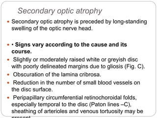 Optic atrophy and neuroretinitis | PPTX