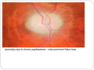 Optic atrophy and neuroretinitis | PPTX