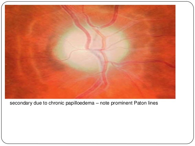 Optic atrophy and neuroretinitis