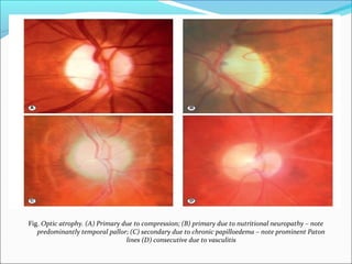 Optic atrophy (b) | PPT