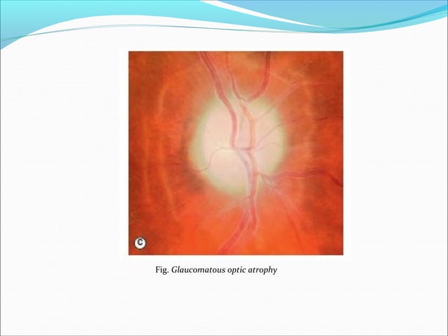 Optic atrophy (b) | PPT
