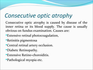 Optic atrophy (b) | PPT
