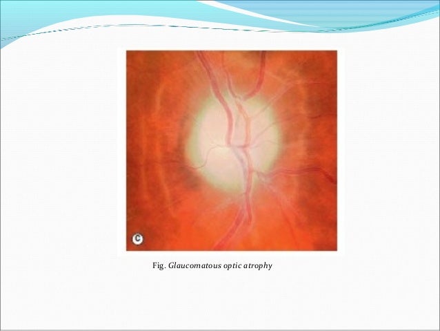 Optic atrophy (b)