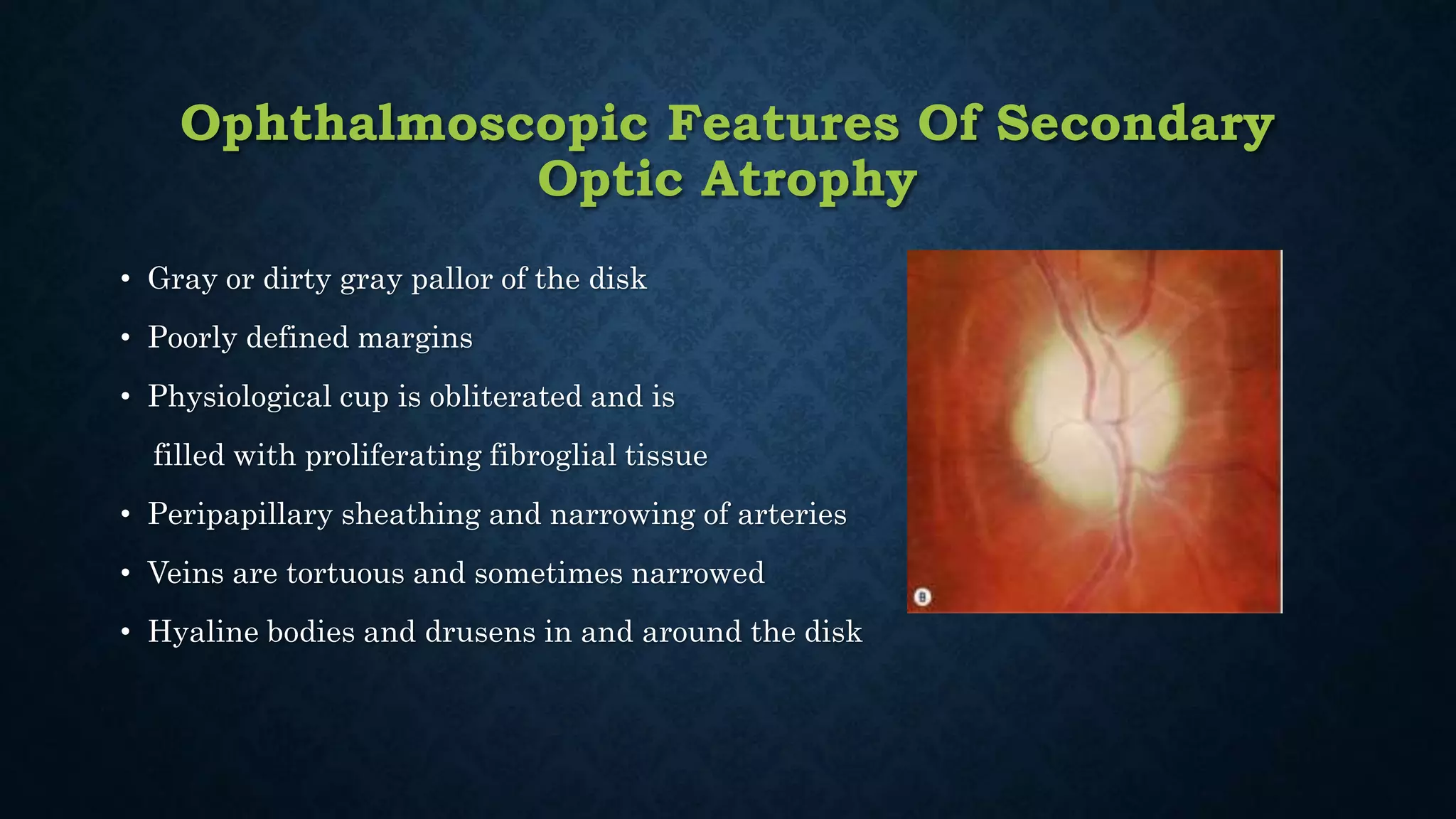 Optic atrophy ppt | PPTX