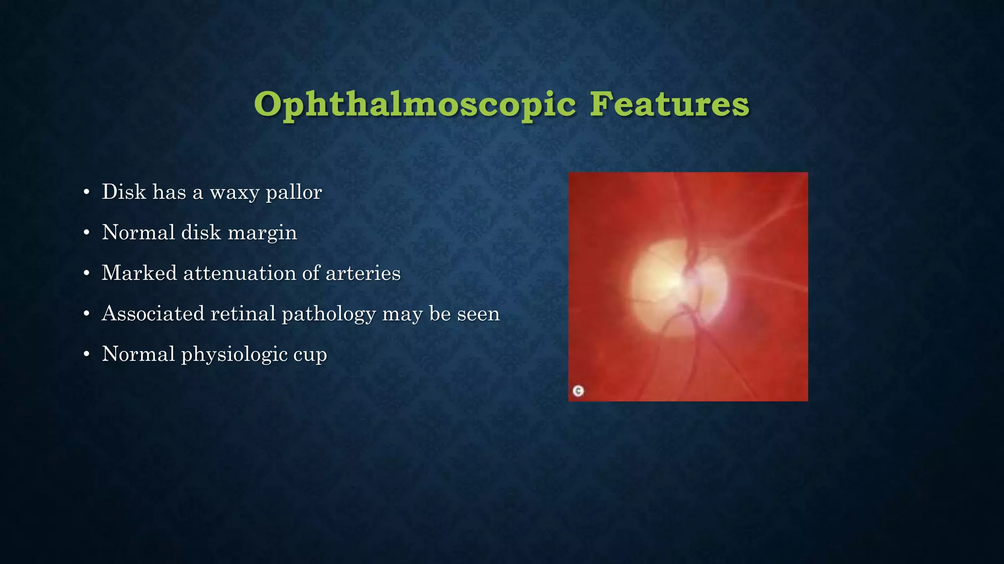 Optic atrophy ppt | PPTX