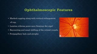 Optic atrophy ppt | PPTX