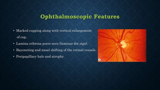 Optic atrophy ppt | PPTX